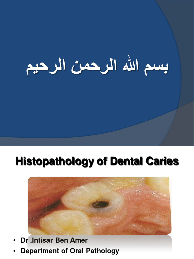Histopathology of Dental Caries Overview | PDF | Tooth Enamel | Dentin