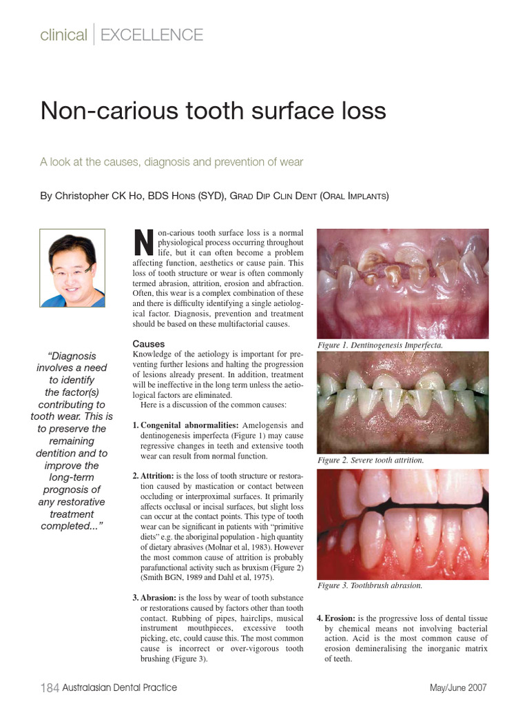 Causes and Prevention of Tooth Wear | PDF | Dentistry Branches | Health ...