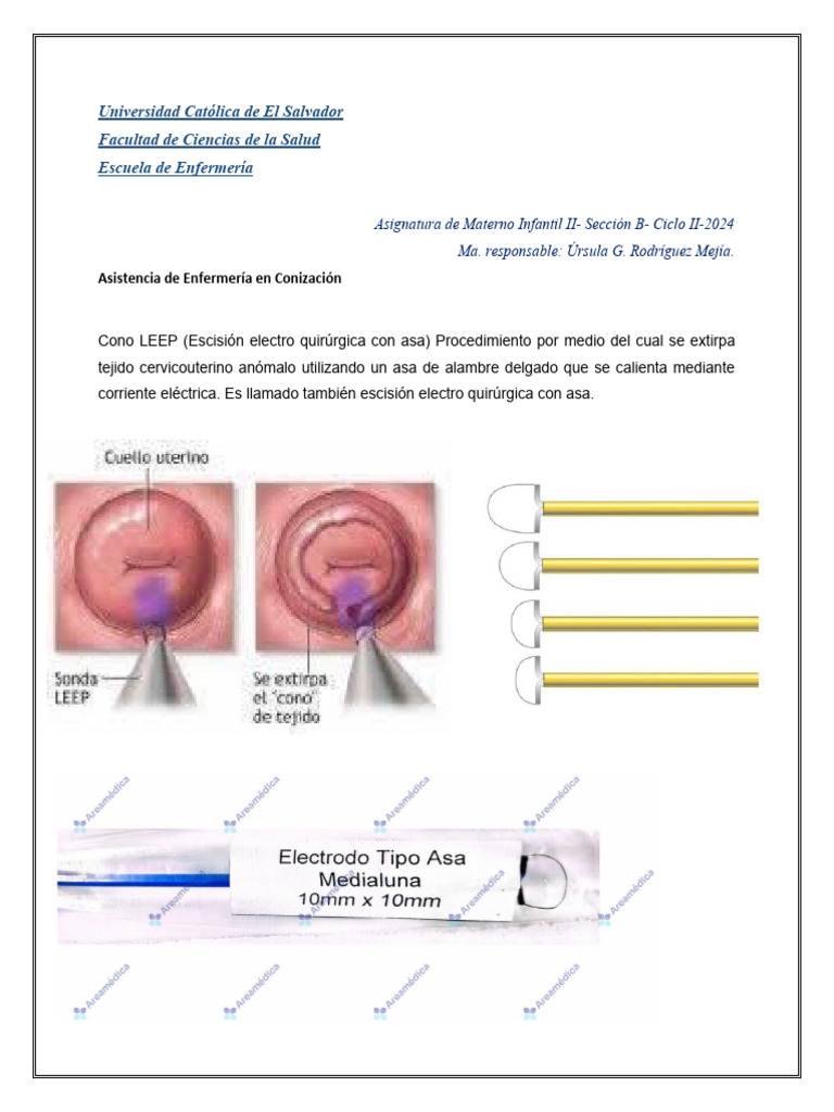 Asistencia en Cono LEEP | PDF | Biopsia | Cáncer