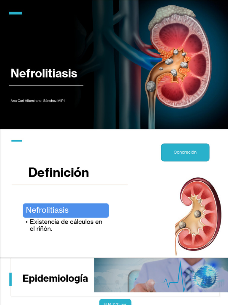 Nefrolitiasis | Descargar gratis PDF | Urología | Medicina CLINICA