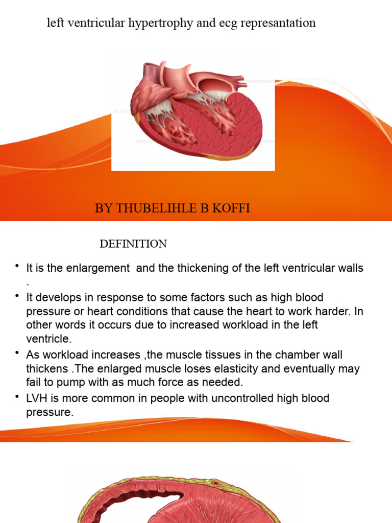 4.left Ventricular Hypertrophy & Ecg Represantatio | PDF ...