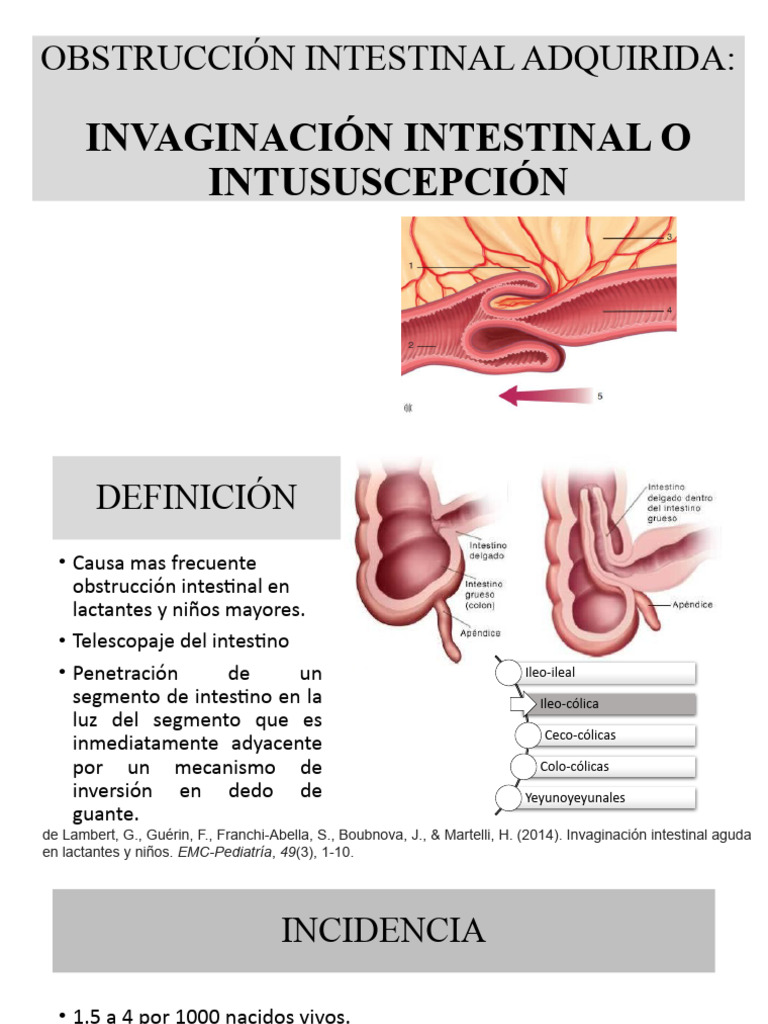 Invaginación Intestinal CX Pediatrica | PDF | Abdomen | Causas de la muerte