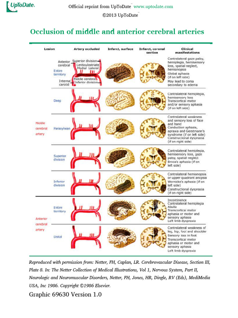 Occlusion of Middle and Anterior Cerebral Arteries | PDF