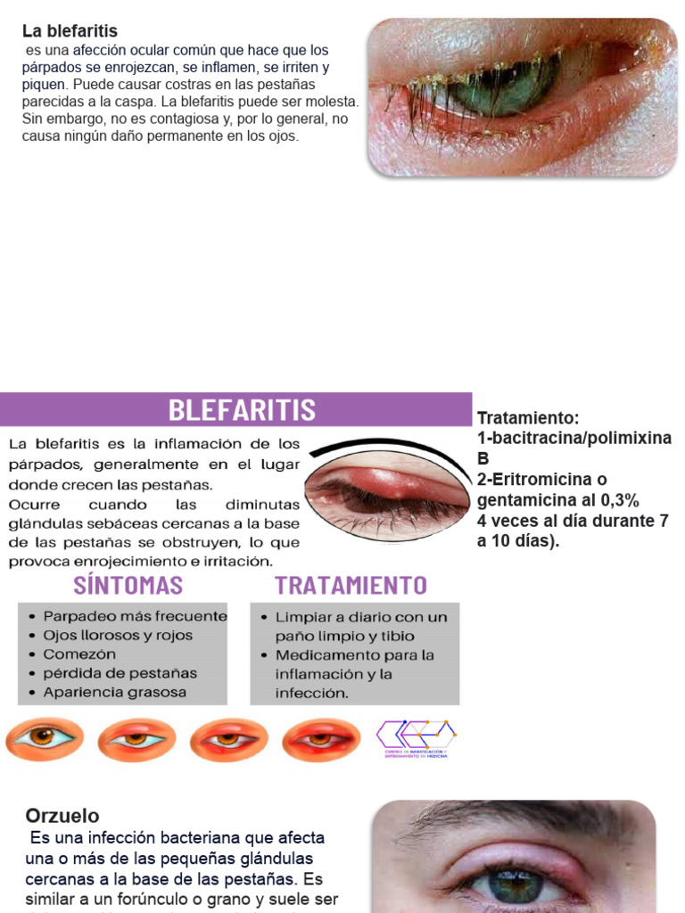 Enfermedades Oculares: Blefaritis, Orzuelo y Conjuntivitis | PDF | Alergia | Ojo humano