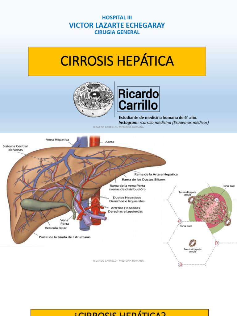 Cirrosis Hepática - Carrillo | Descargar gratis PDF | Cirrosis | Especialidades Medicas