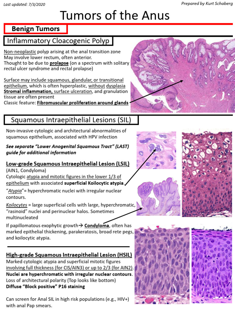 Anal Tumors | PDF | Epithelium | Carcinoma