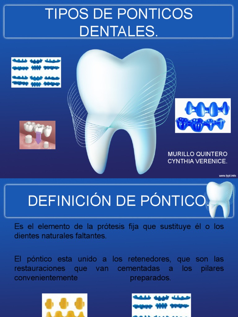 tipos de ponticos | Dentaduras | Diente humano