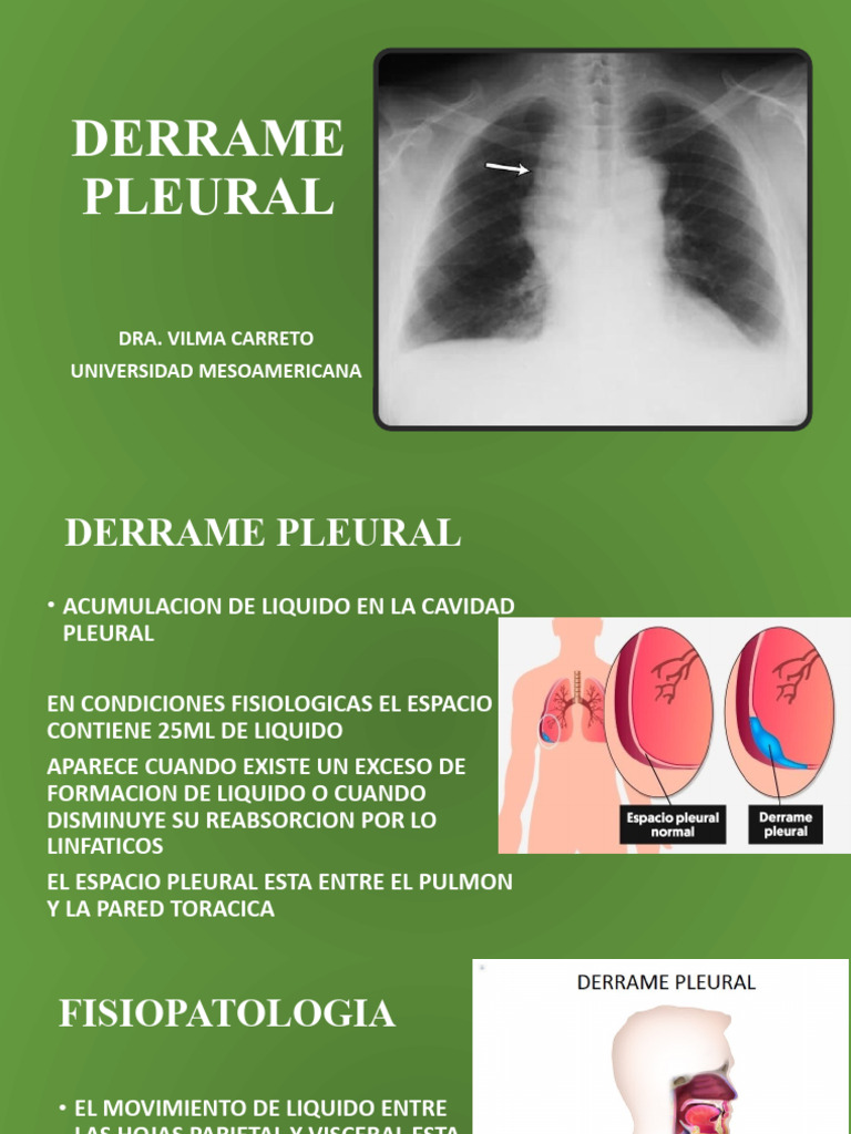 DERRAME PLEURAL | PDF | Medicina CLINICA | Epidemiología