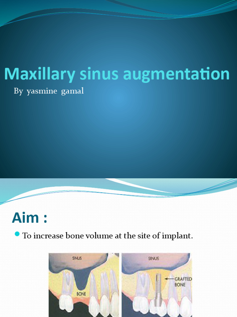 Maxillary Sinus Augmentation | PDF | Bone | Tissue (Biology)
