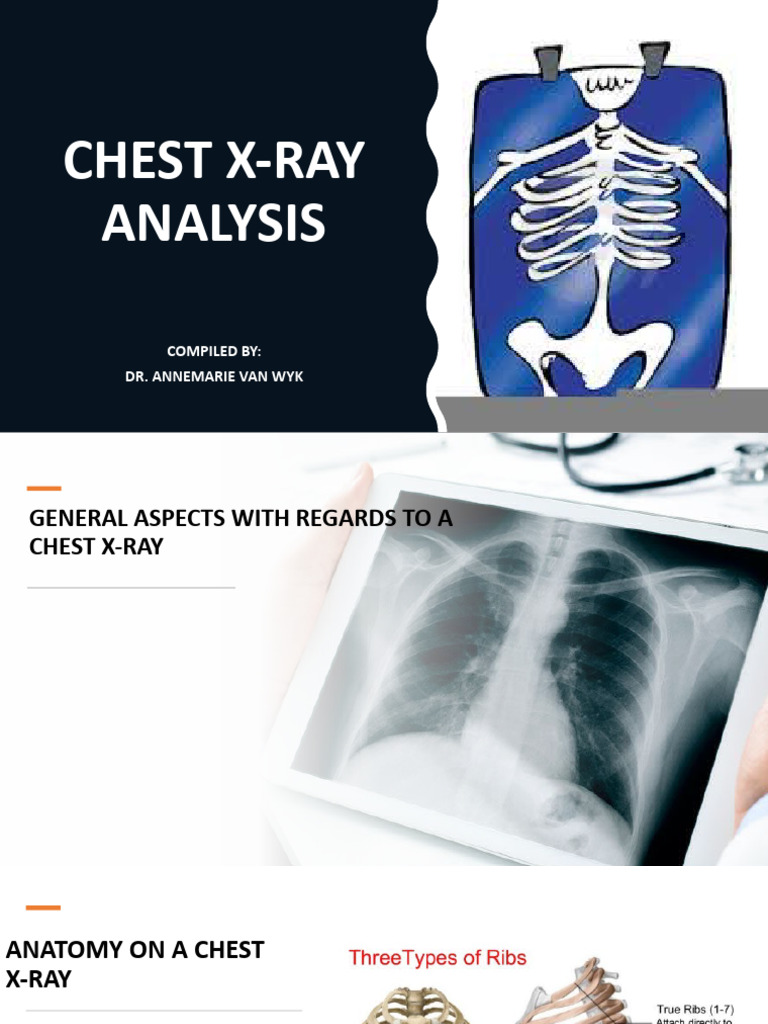 Chest X-Ray Analysis 2023 | PDF | Lung | Thorax