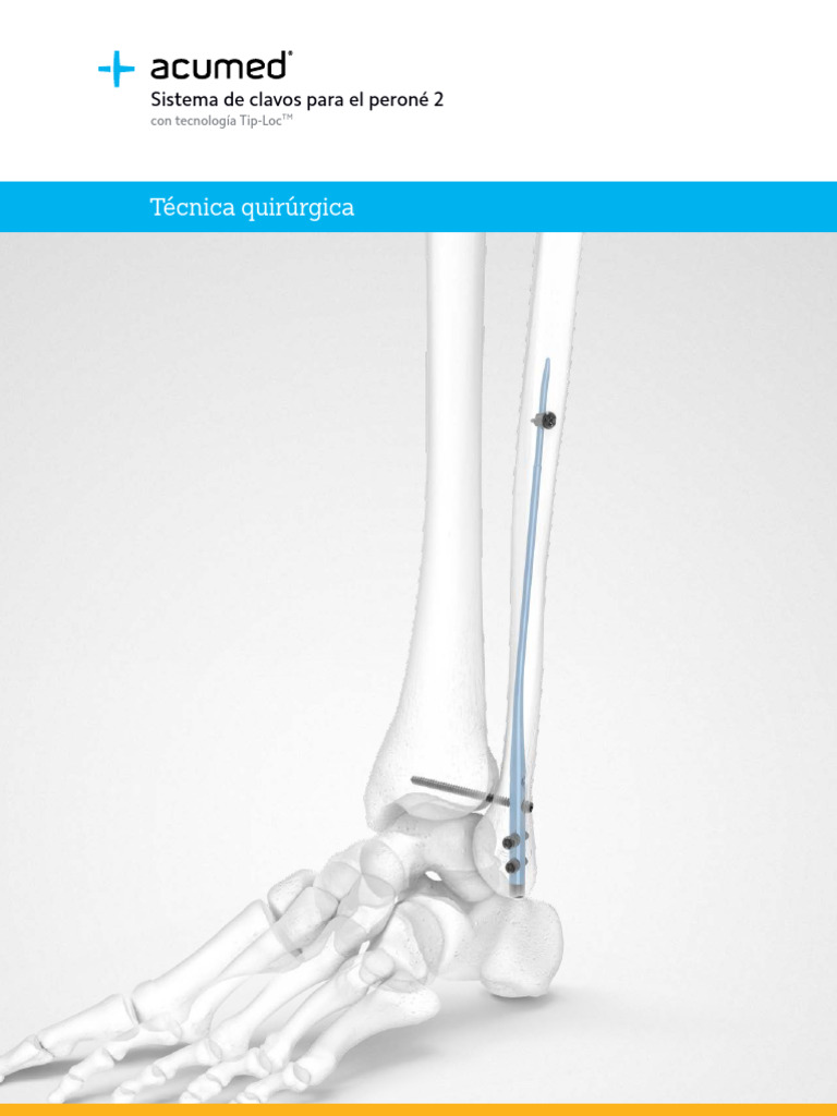 Acumed ES Surgical Technique Fibula Nail 2 ESFNA10 02 A | PDF