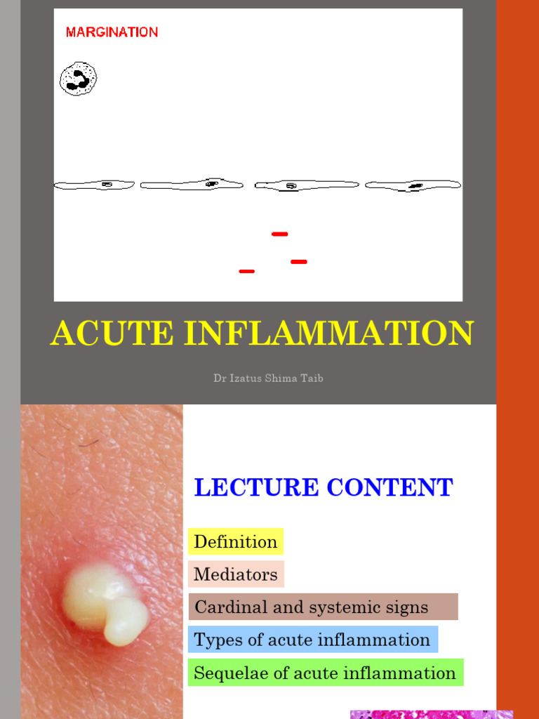Acute Inflammation | PDF | Inflammation | Macrophage