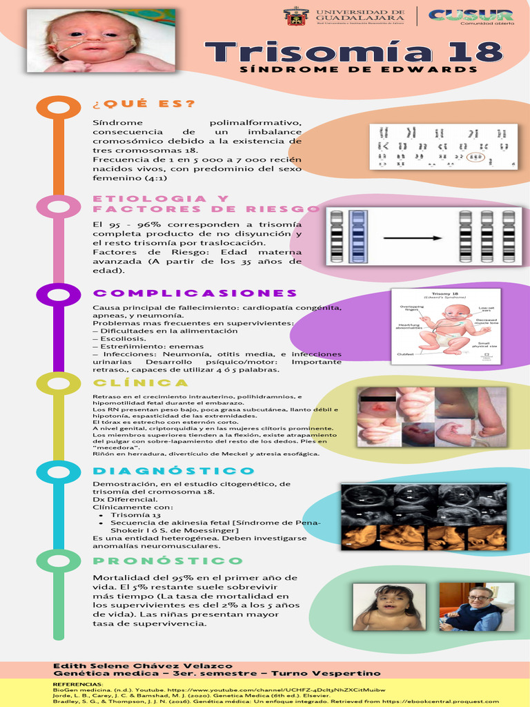 Infografía - Trisomía 18 Síndrome de Edwards | PDF