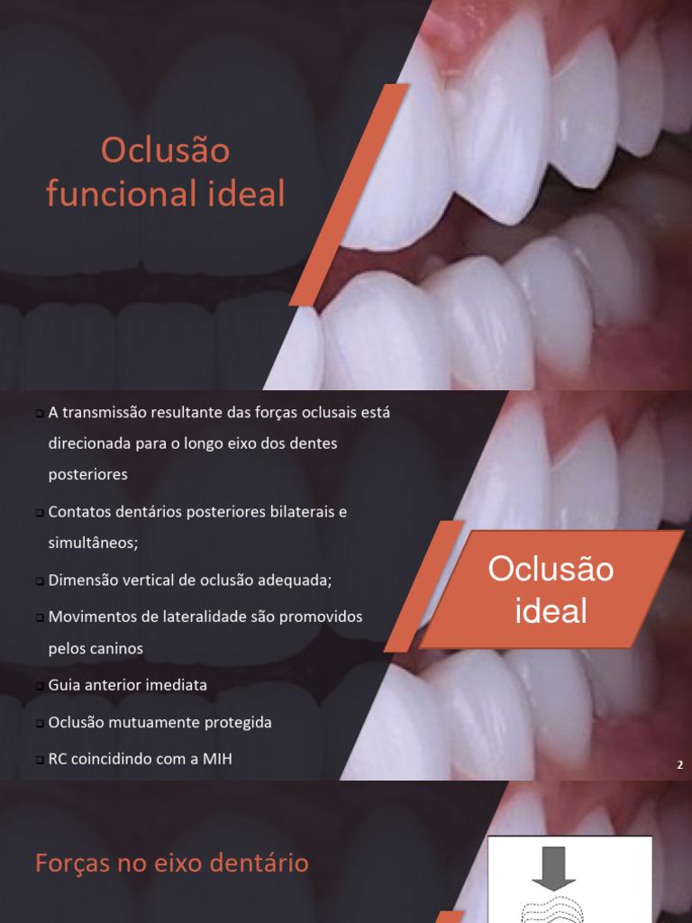 Chaves de Andrew Ma Oclusao de Angle | PDF