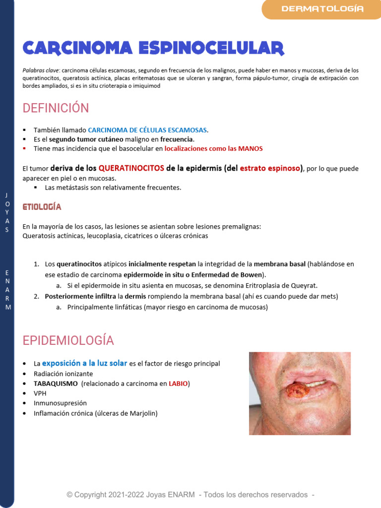 Carcinoma Espinocelular | PDF | Cáncer | Medicina