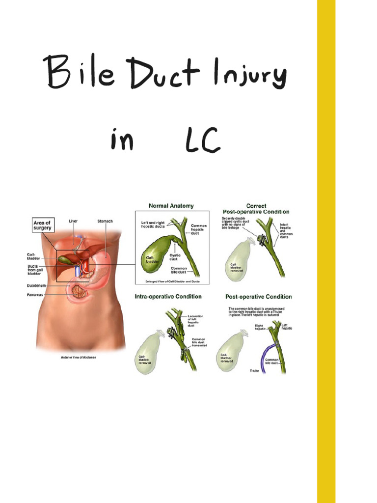 Bile Duct Injury in LC | PDF
