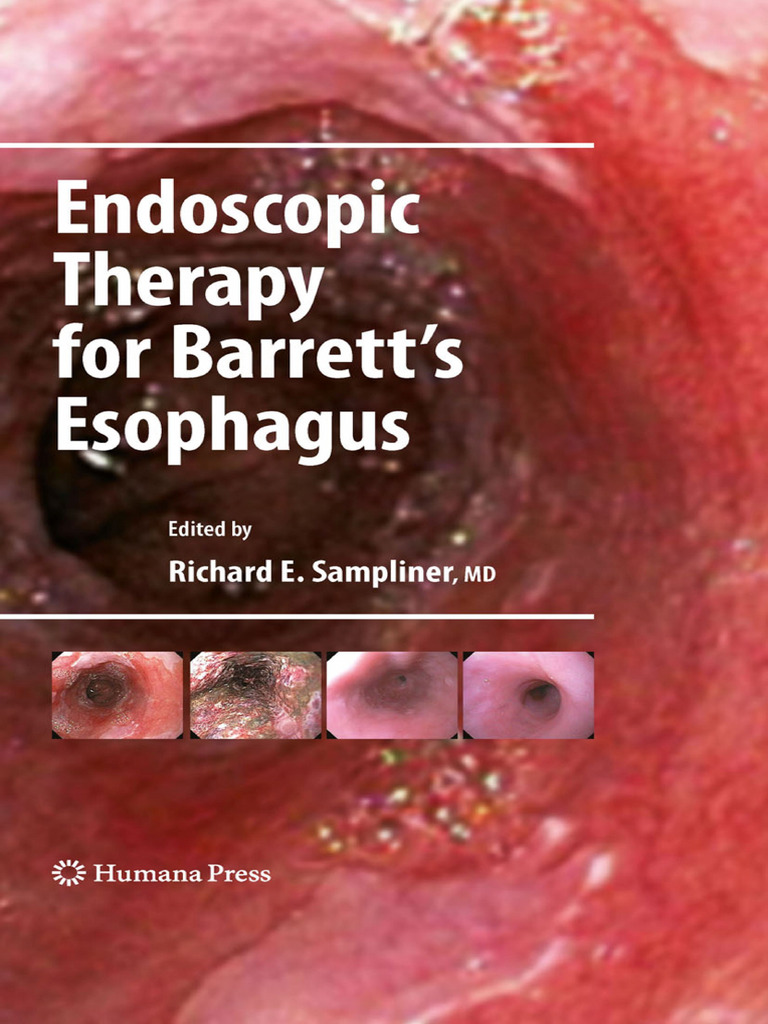 Endoscopic Therapy For Barrett - S Esophagus | PDF | Charge Coupled ...