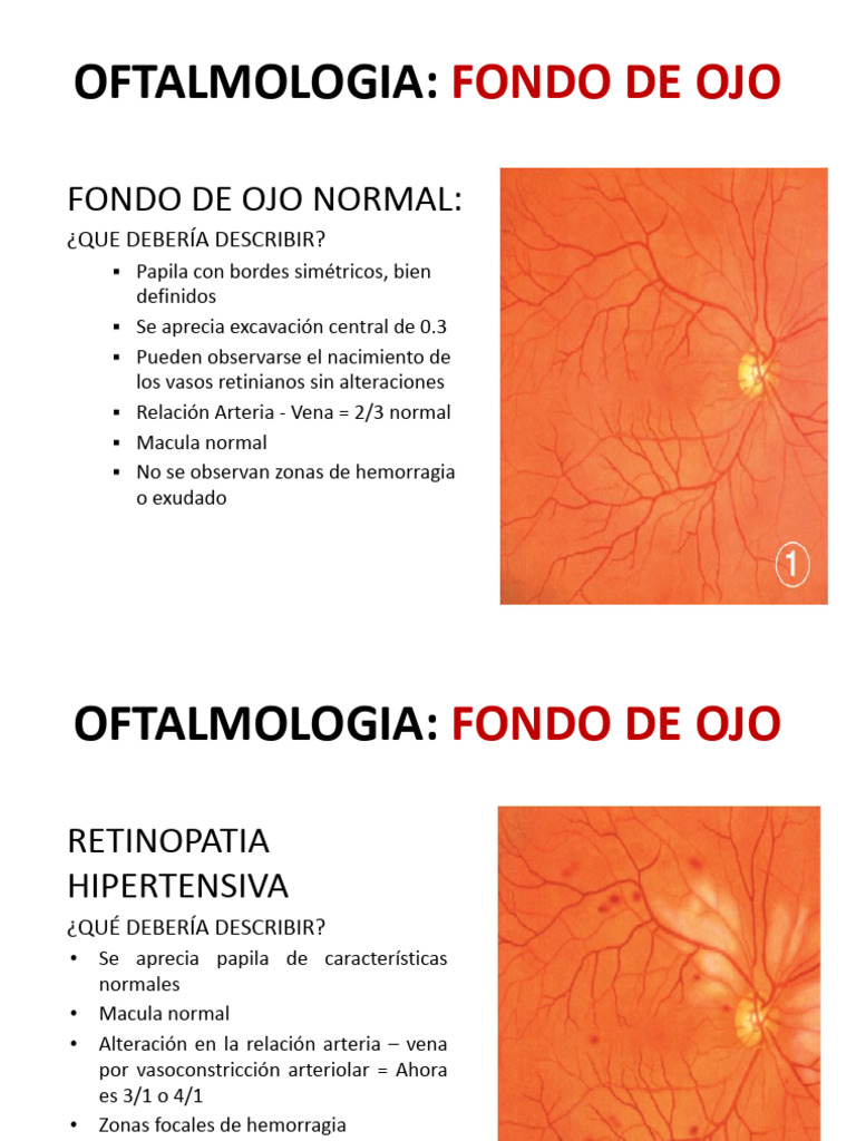 Descripción del Fondo de Ojo Normal y Anormal | PDF
