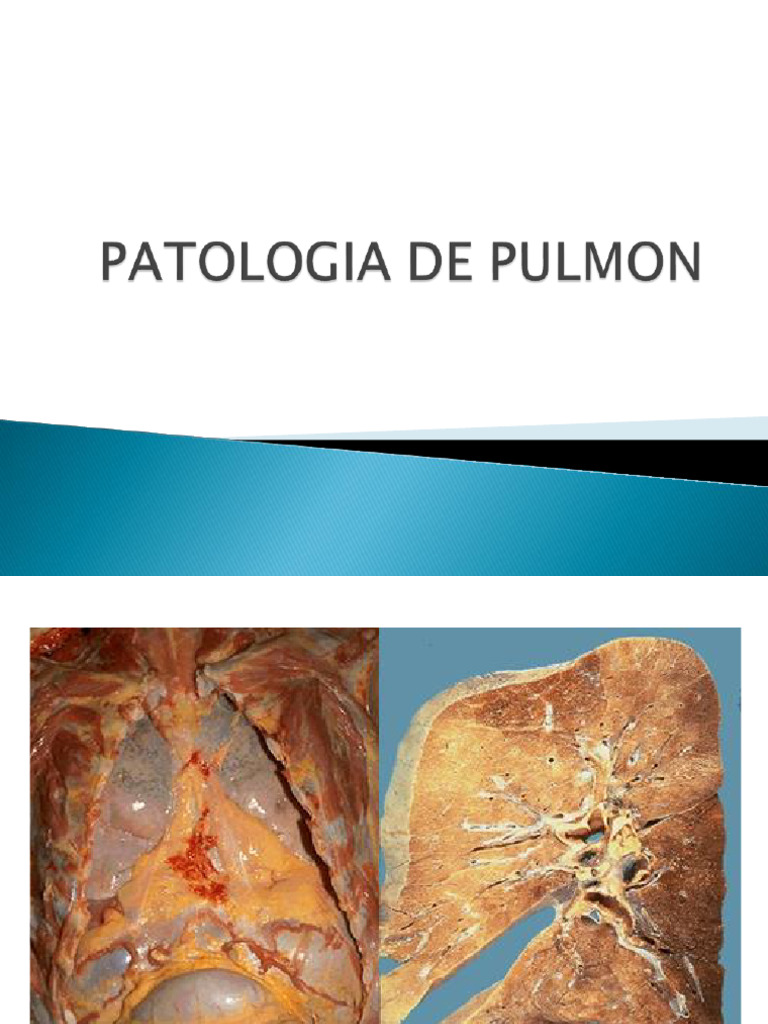 Tema 5. Patologia de Pulmon | PDF | Neumonía | Tos