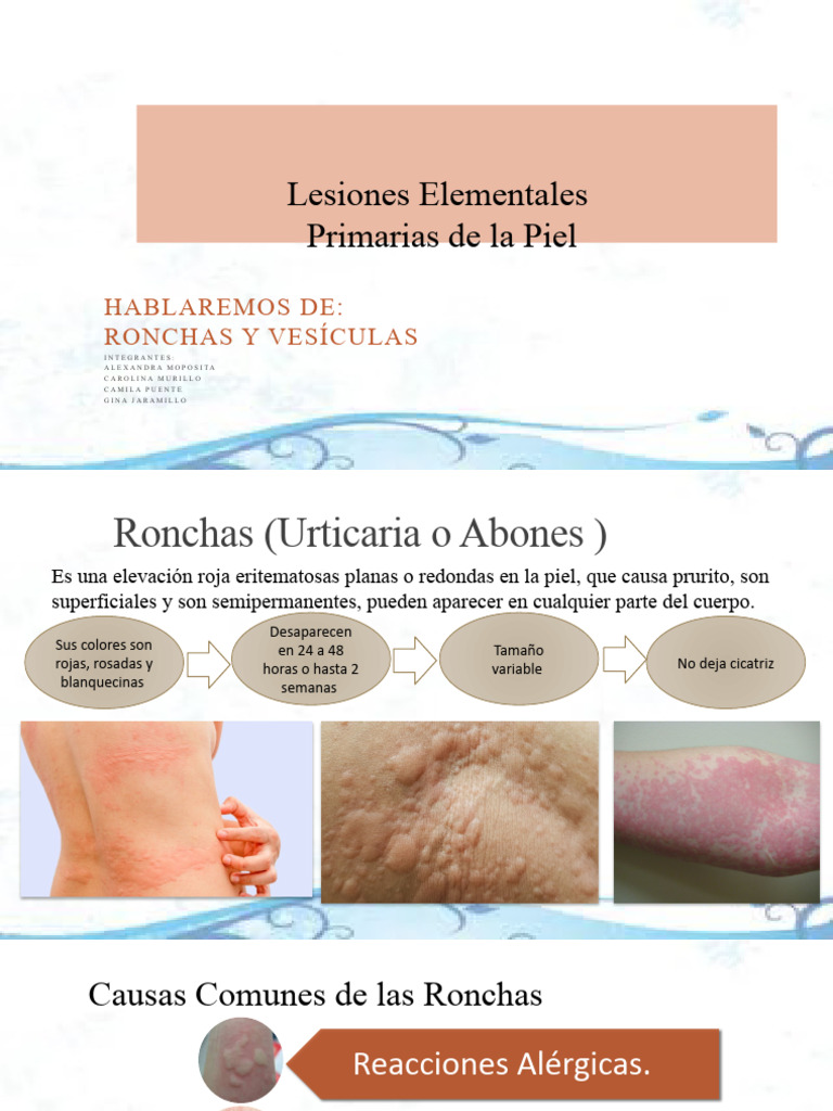 Lesiones de La Piel Ronchas y Vesiculas | PDF