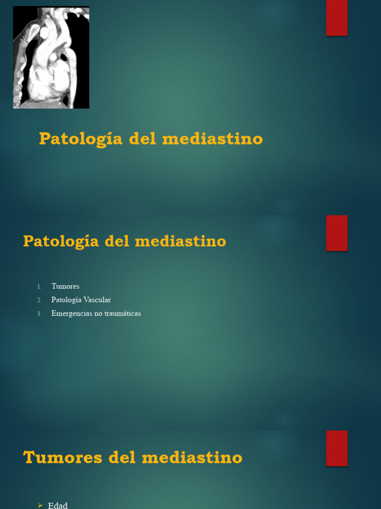 03 Mediastino Patologico | PDF | Neoplasias | Linfoma