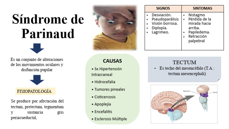 Sindrome de Parinaud | PDF