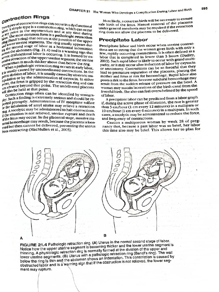 Contraction Rings and Precipitate Labor | PDF