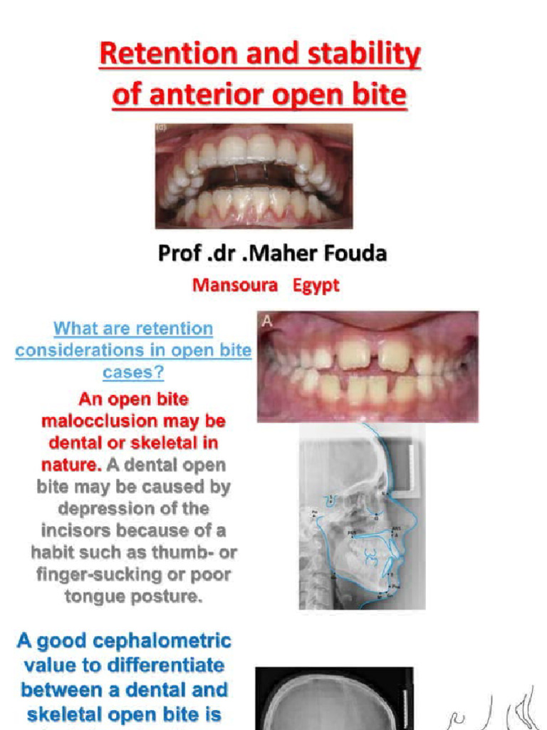 Retention of Open Bite | PDF