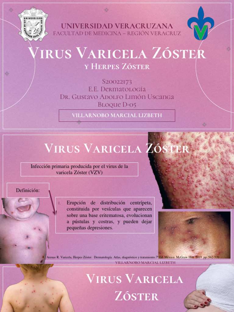 Virus Varicela Zóster - Villarnobo Marcial Lizbeth D-05 | PDF | Herpes ...