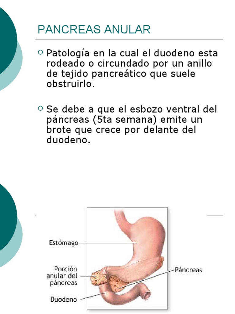 Pancreas Anular: Causas, Síntomas y Tratamiento de esta Patología ...