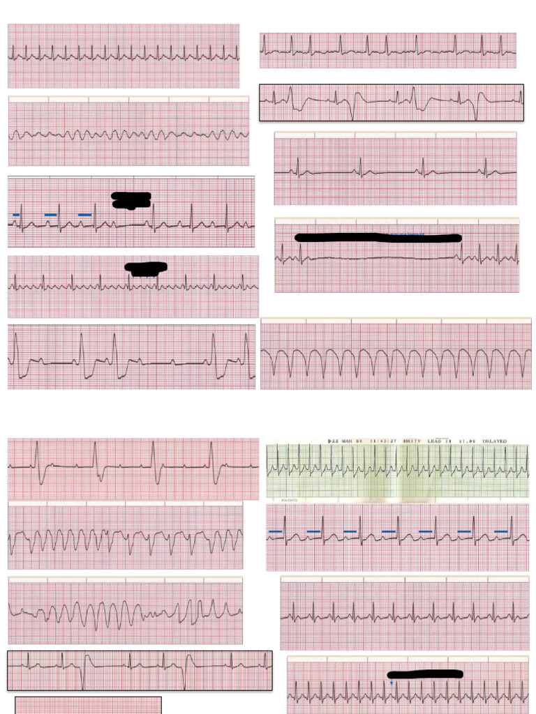 ECG Pics Practice | PDF