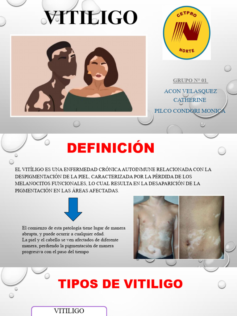 Vitiligo: Tipos, Causas y Tratamientos | PDF | Especialidades Medicas ...