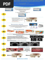 Guía fácil Neodent Helix GM Narrow | PDF | Implante dental | Cirugía