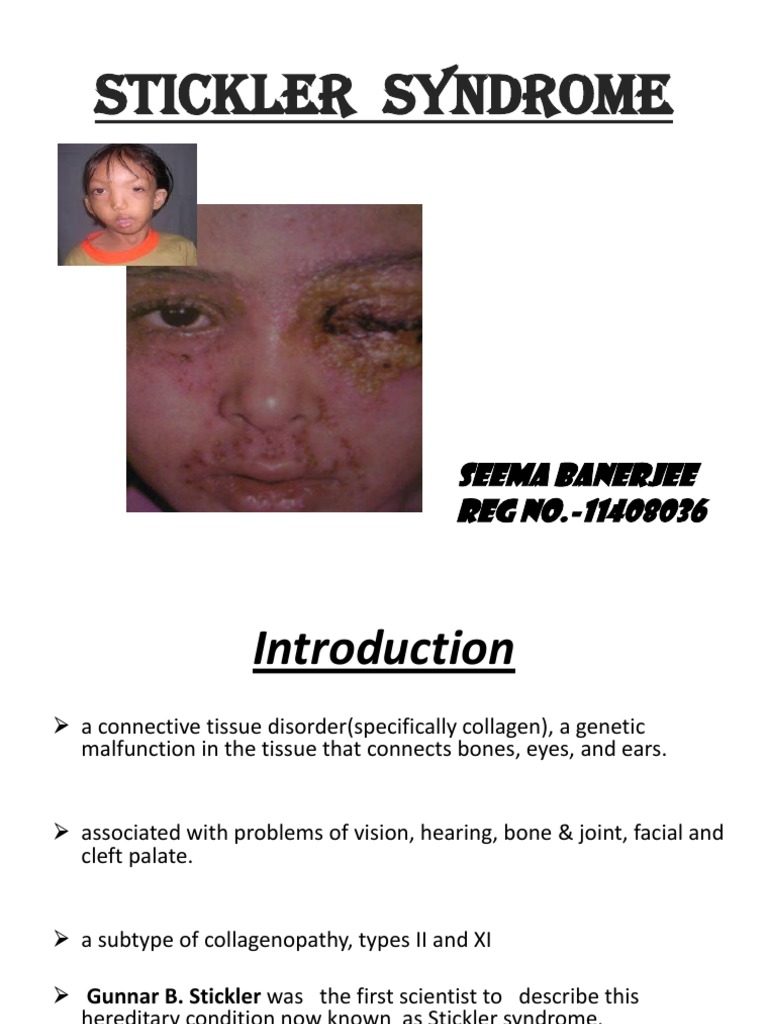 Stickler Syndrome | PDF | Collagen | Medical Specialties