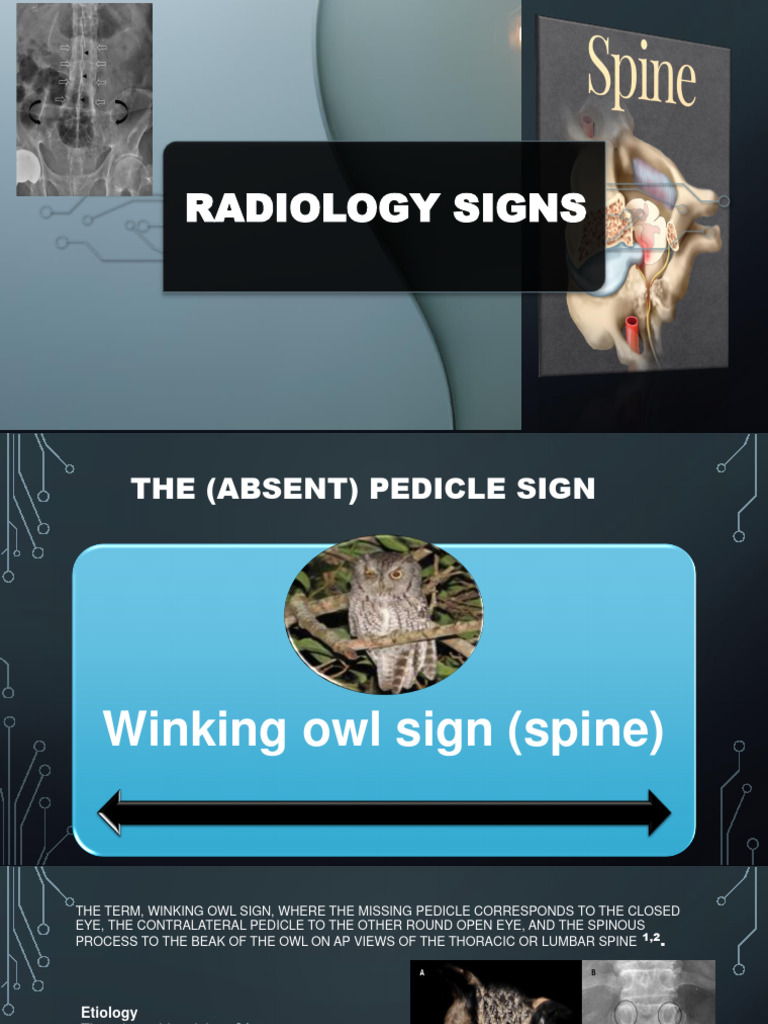 Radiology Sign | PDF | Vertebral Column | Spinal Cord