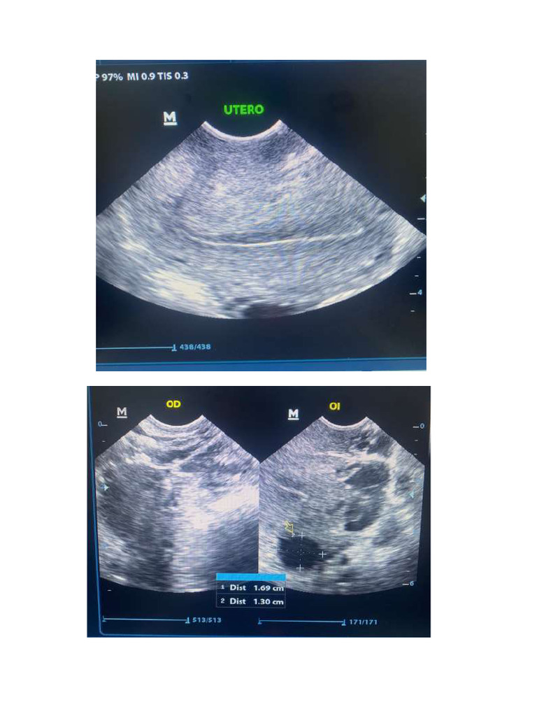 Descripción Útero y Ovarios | PDF