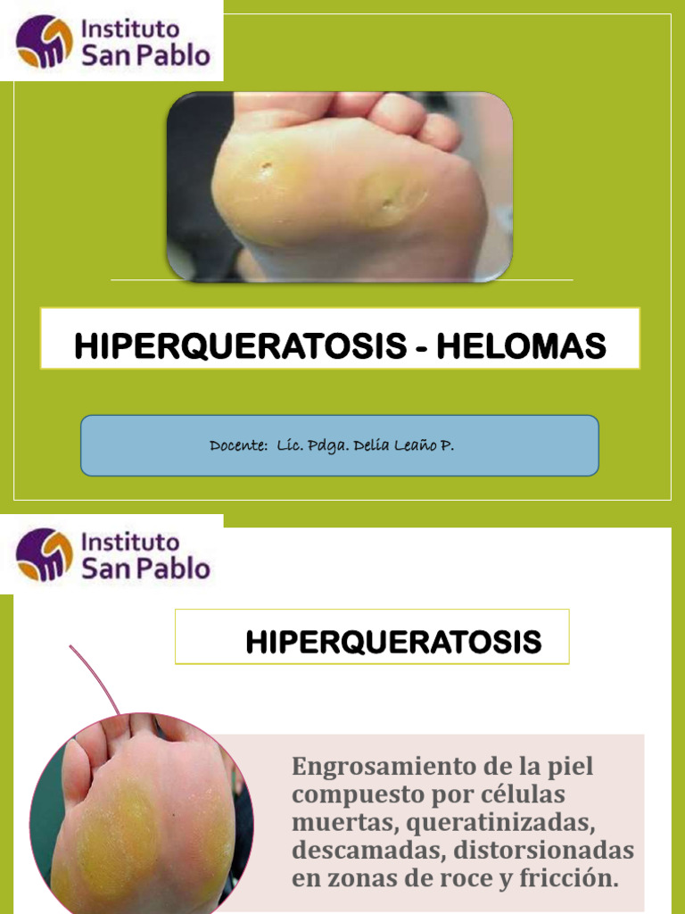 Hiperqueratosis y Helomas: Tipos y Tratamiento | PDF | Especialidades ...
