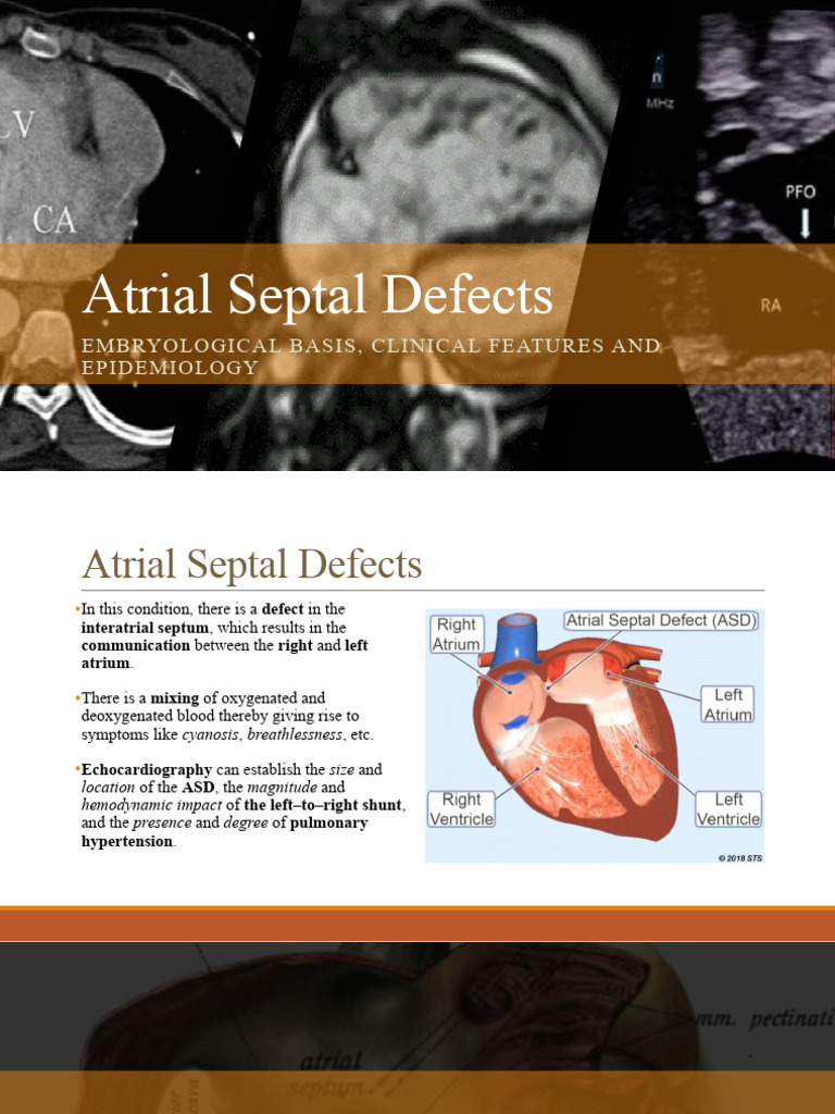 Atrial Septal Defects | PDF | Atrium (Heart) | Cardiovascular Diseases