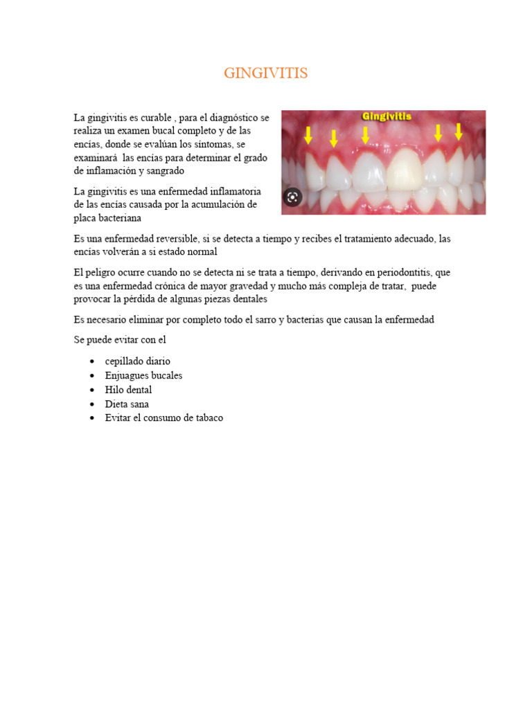 Gingivitis | PDF