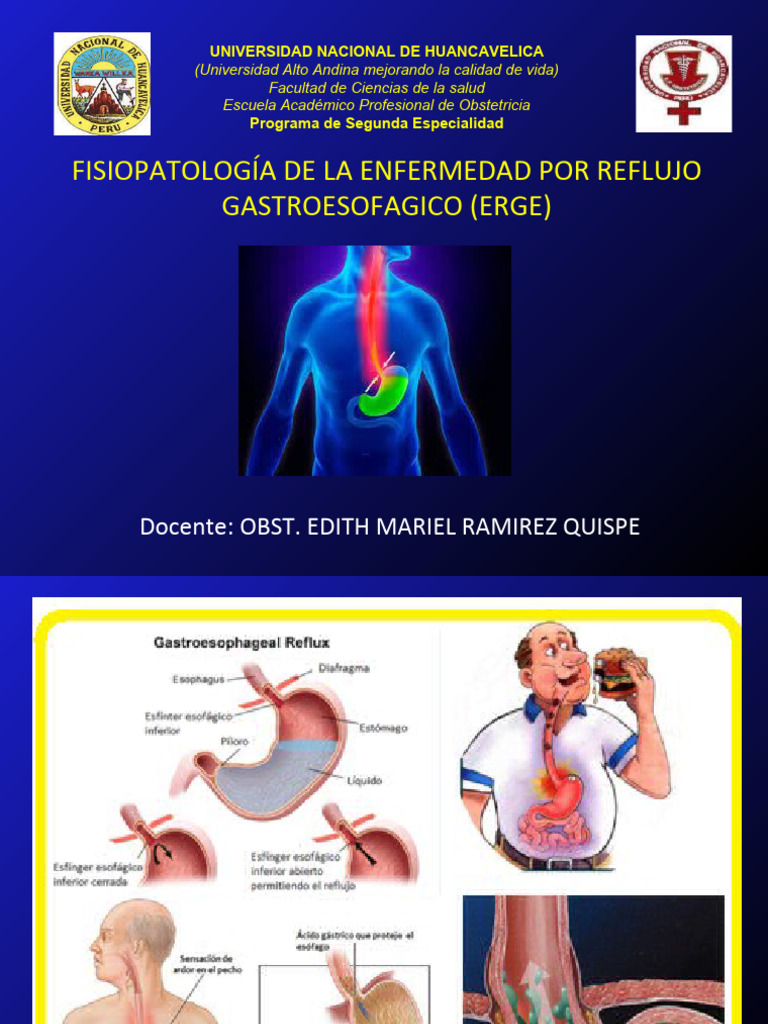 5 Enfermedad Por Reflujo Gastroesofagico | PDF | La enfermedad por ...