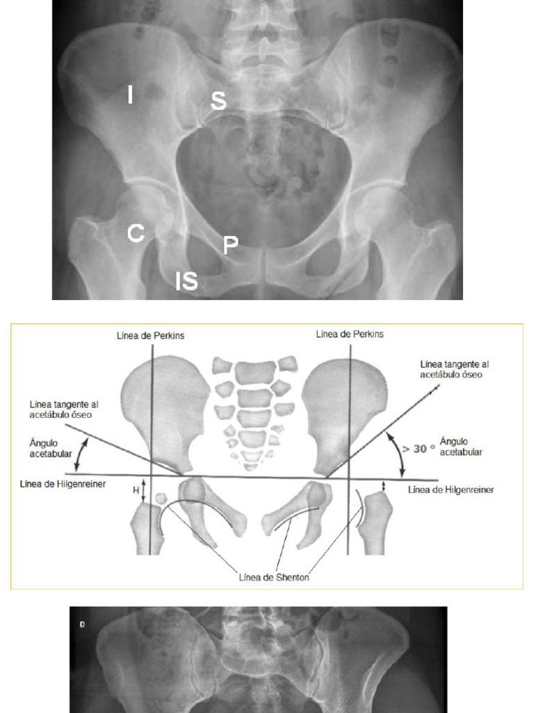RX Cadera Femur | PDF