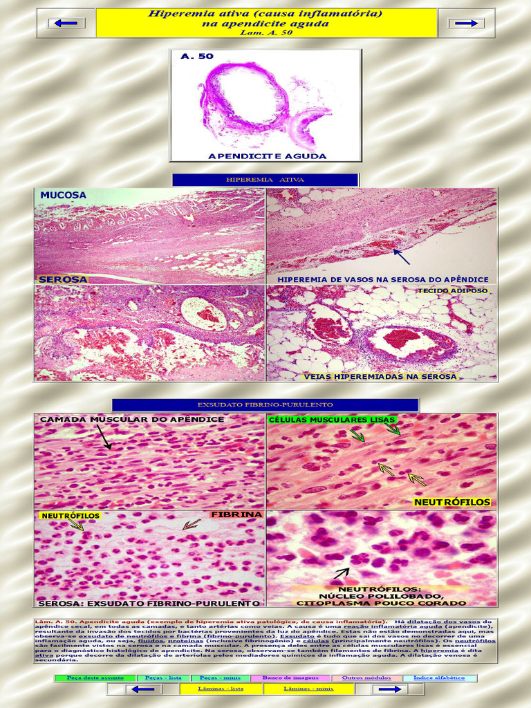 Hiperemia Ativa na Apendicite Aguda | PDF