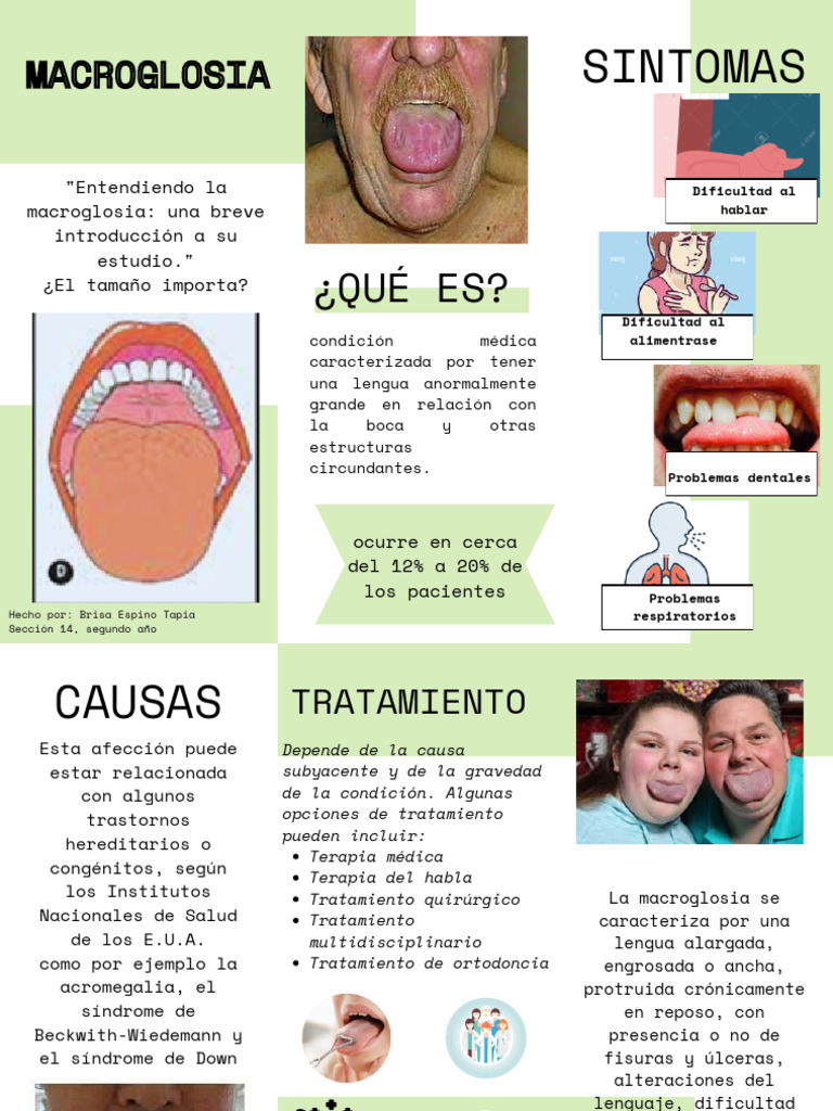 Triptico MACROGLOSIA | PDF | Medicina | Epidemiología