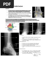 The Radiology Assistant - Ankle Fracture - Weber and Lauge-Hansen ...