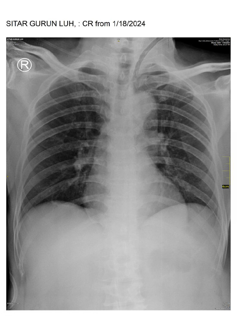 Rontgen Thorax Luh Sitar Gurun | PDF