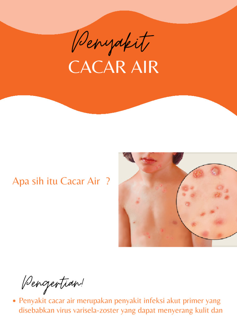Sesi 15 Penyakit Cacar Air | PDF