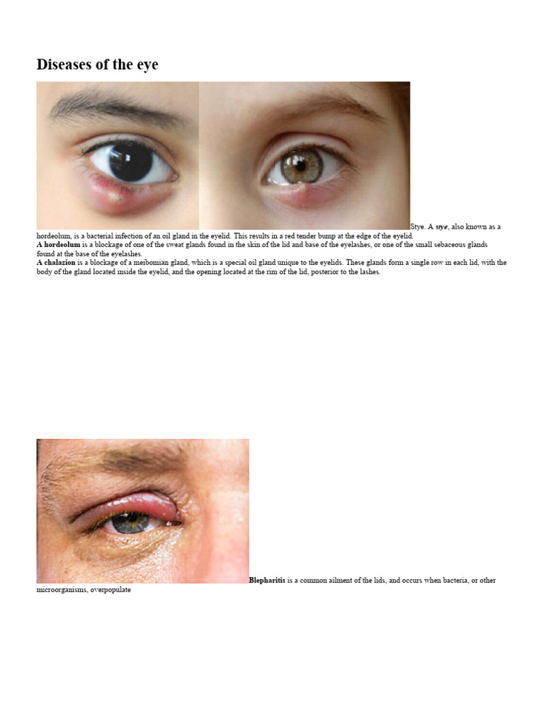 Diseases of The Eye | PDF | Glaucoma | Epidemiology