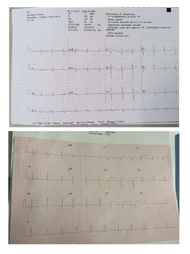 EKG | PDF