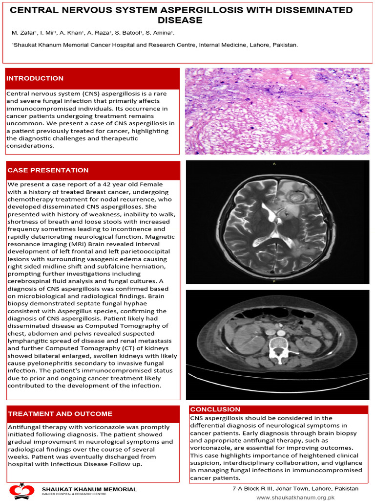Cns Aspergillosis Poster FINAL | PDF
