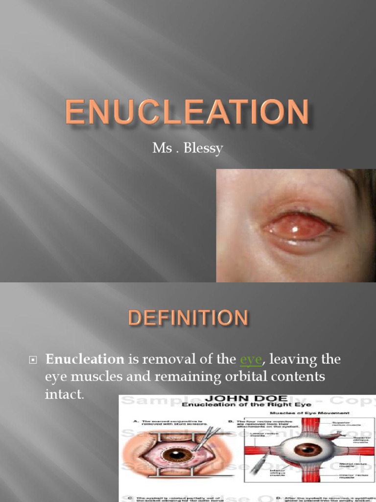 ENUCLEATION | PDF | Implant (Medicine) | Surgery